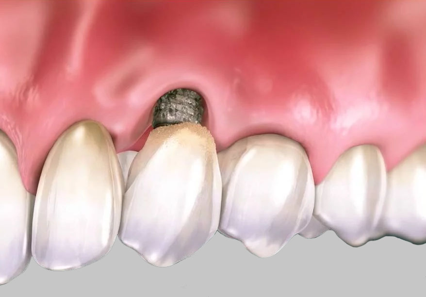 Rechazo del Implante Dental: Entendiendo las Causas y Síntomas - Class Dent